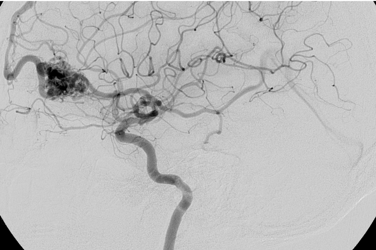 What to Expect After AVM Removal | South Sound Gamma Knife